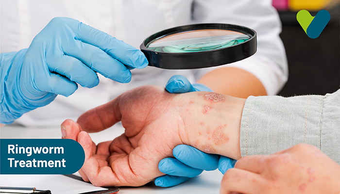 Ringworm Treatment: Effective Diagnosis & Treatment For Ringworm ...